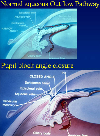 Intraocular Pressure (IOP)