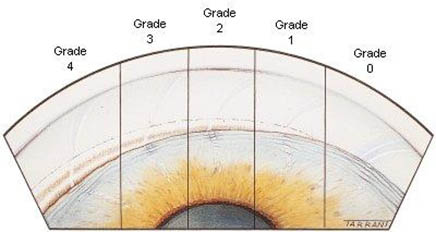 Intraocular Pressure (IOP)